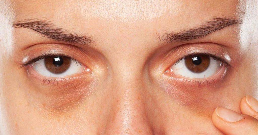 Astuces et conseils pour les poches sous les yeux et les cernes
