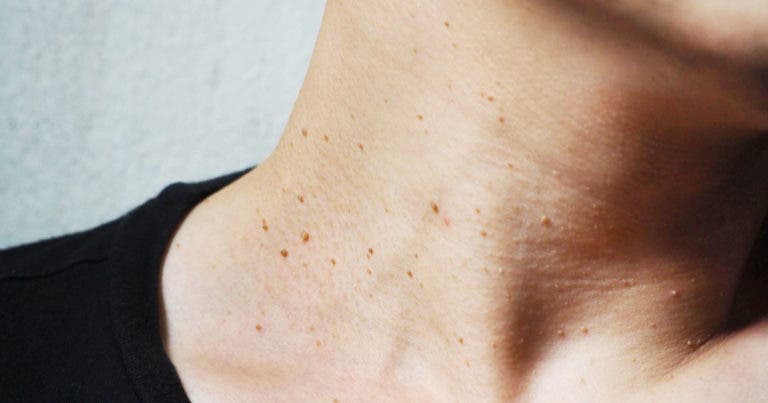 "Boutons" autour des yeux et sur le corps : découvrez les causes et les ...