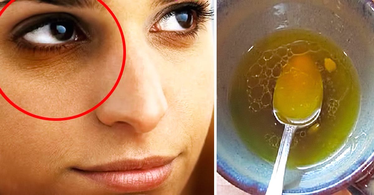 Comment effacer les rides sous les yeux naturellement ? 5 astuces ...