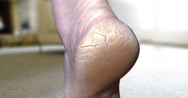 Crevasses au pied : 11 remèdes de grand-mère pour soulager les talons ...