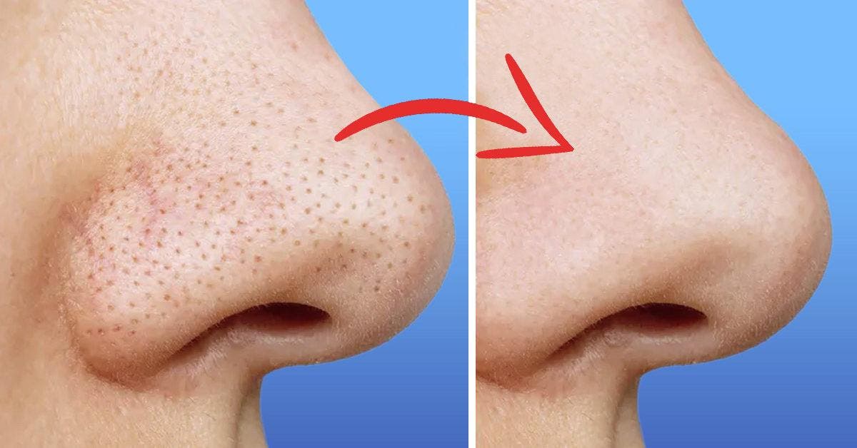 Comment enlever les points noirs ? 4 recettes de grand-mère