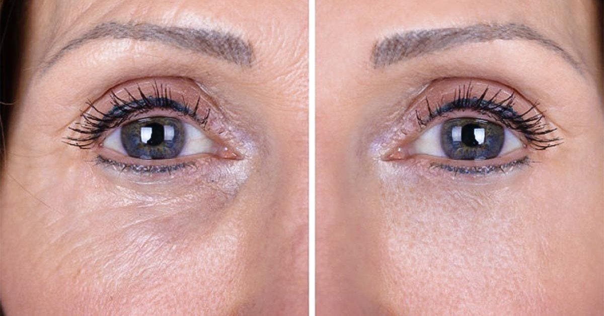 5 astuces de grands-mères pour estomper les cernes sous les yeux