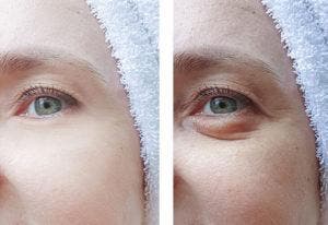 Dégonflez les poches sous vos yeux grâce à cette astuce naturelle