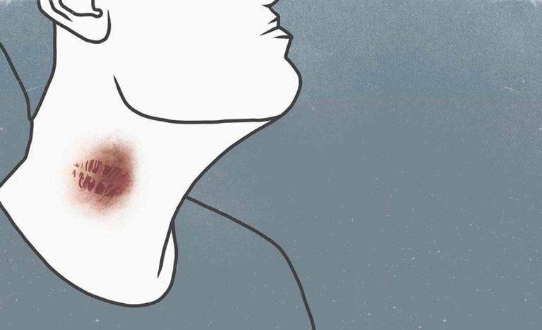 Comment enlever un suçon : le guide pour le faire disparaître et le cacher