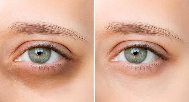 3 masques naturels pour éliminer les cernes