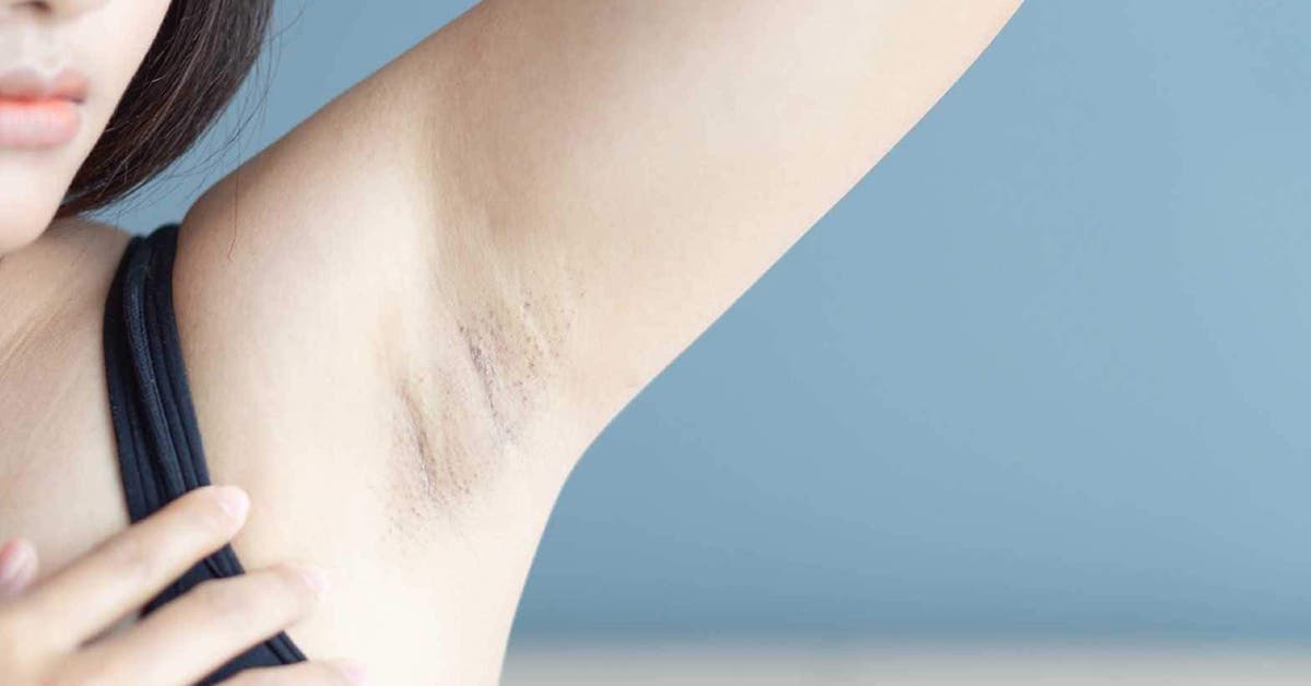 Éclaircir les aisselles : 7 astuces naturelles pour avoir un effet ...