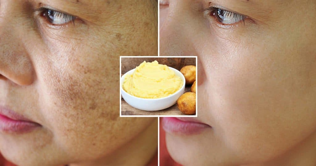 Acide Hyaluronique : quels sont les bienfaits pour la peau et comment l ...