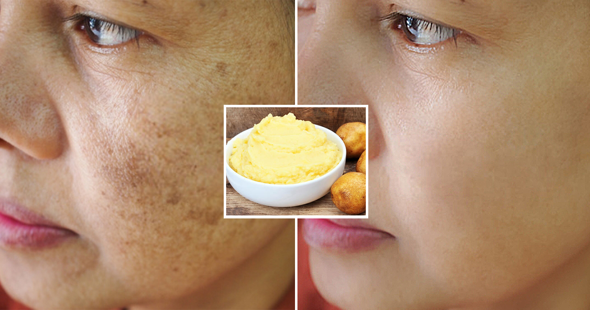 Acide hyaluronique : bienfaits et utilisation pour une peau éclatante