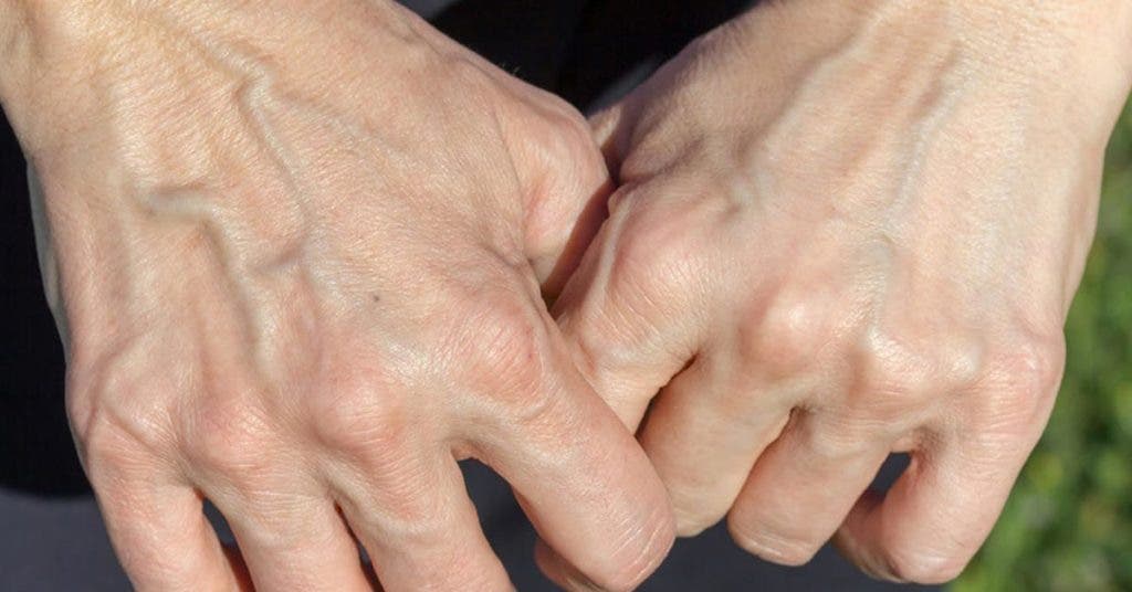 Pourquoi certaines personnes ont-elles les veines apparentes